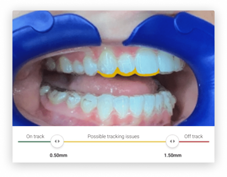 Invisalign Virtual Care AI Woodland Hills CA | Rehil Orthodontics