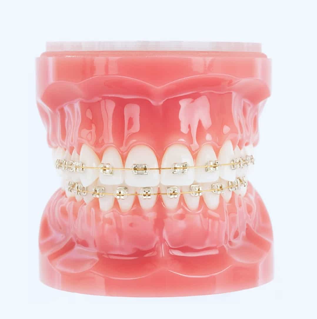 Types of braces Woodland Hills CA | Rehil Orthodontics