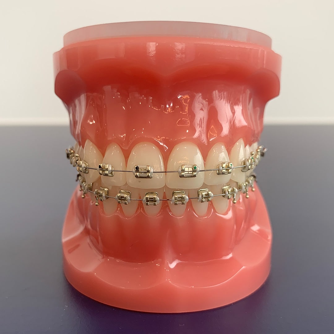 Types of braces Woodland Hills CA | Rehil Orthodontics